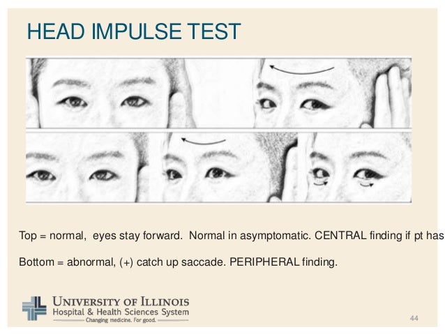 Bppv final -grand rounds sept 2015