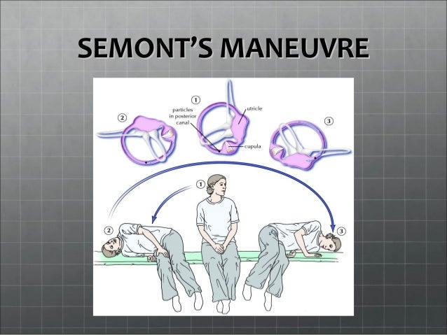 Brandt Daroff Exercises Epley Maneuver