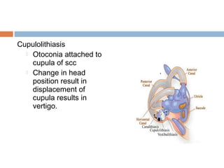 Bppv & vertigo | PPT