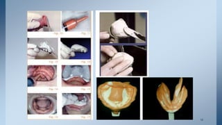 biofunctional prosthetic system | PPTX