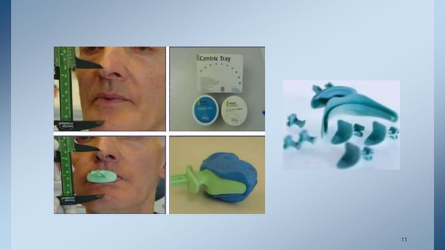 biofunctional prosthetic system | PPTX