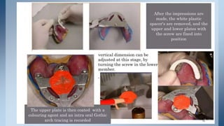 biofunctional prosthetic system | PPTX