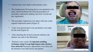 biofunctional prosthetic system | PPTX