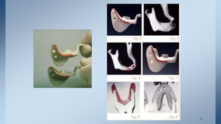 biofunctional prosthetic system | PPTX