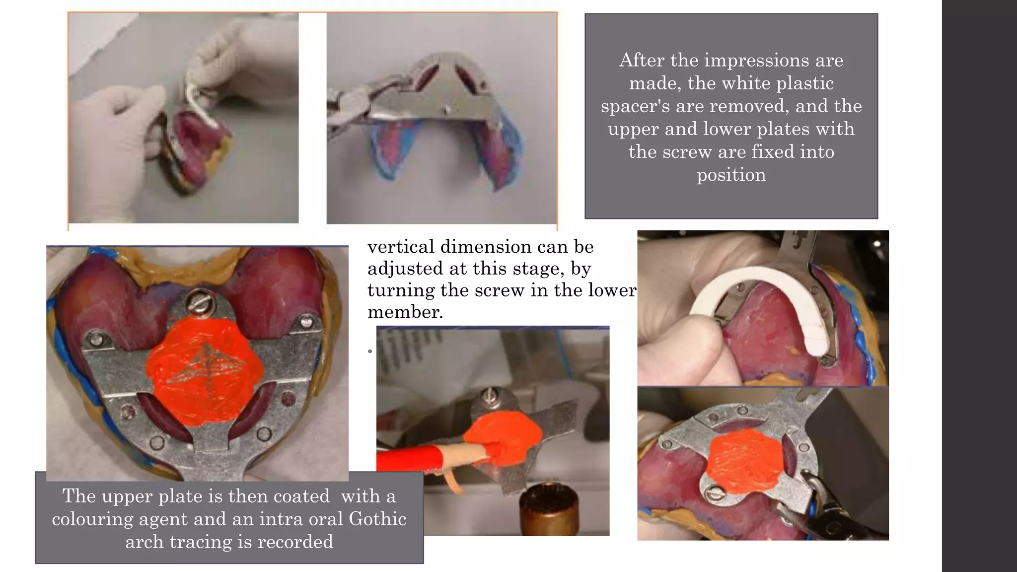 journal cub presentation on Bps denture/biofunctional prosthetic system | PPTX