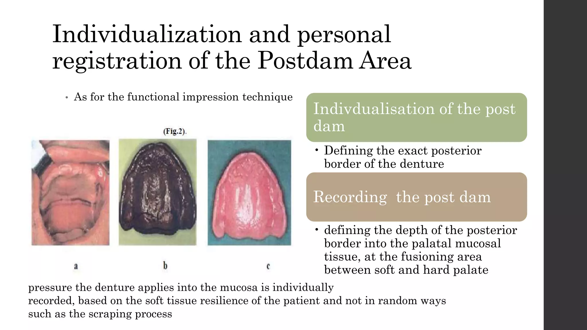 journal cub presentation on Bps denture/biofunctional prosthetic system ...