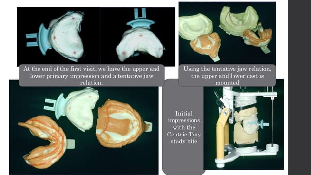 journal cub presentation on Bps denture/biofunctional prosthetic system ...