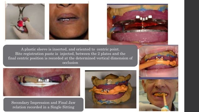 journal cub presentation on Bps denture/biofunctional prosthetic system ...