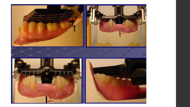 journal cub presentation on Bps denture/biofunctional prosthetic system ...