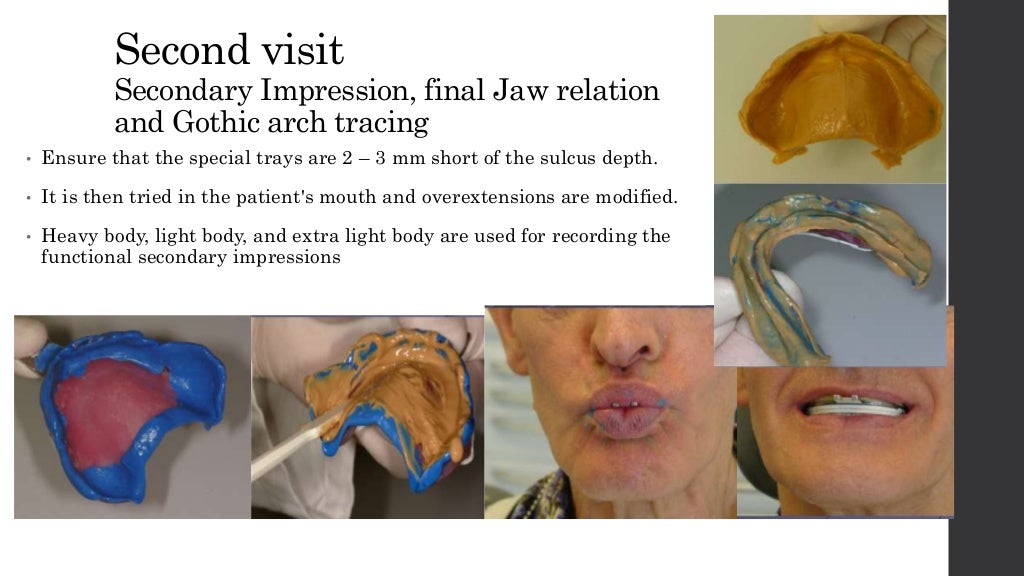 journal cub presentation on Bps denture/biofunctional prosthetic syst…