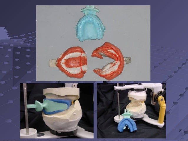 How Dentures are Made - BPS System