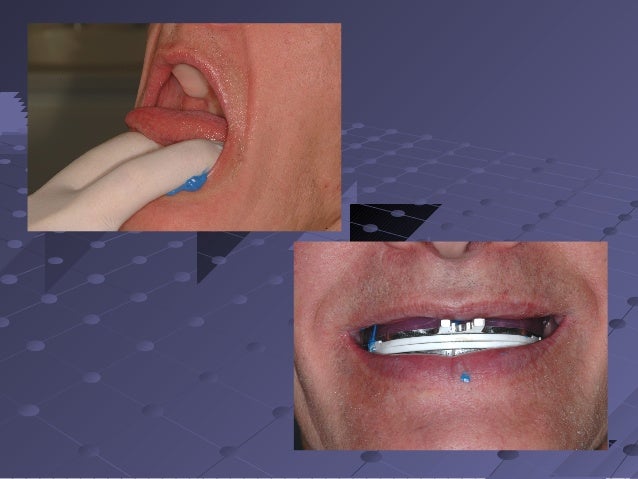 How Dentures are Made - BPS System