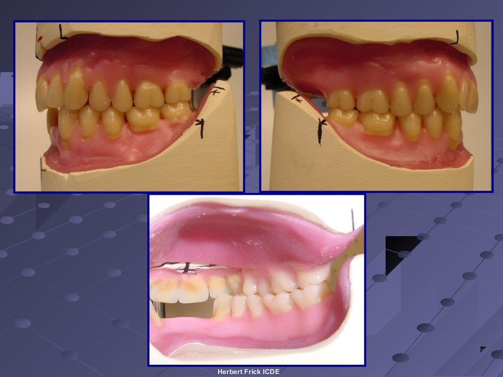 How Dentures are Made - BPS System