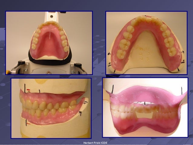 How Dentures are Made - BPS System