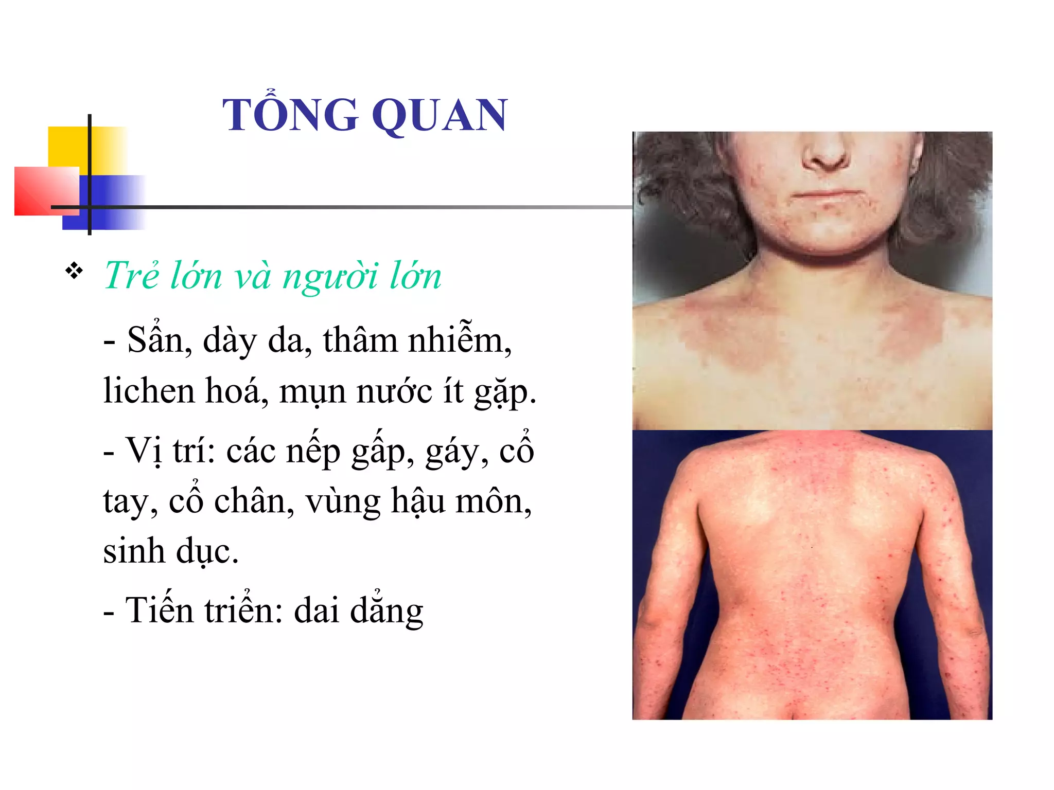 HIỆU QUẢ ĐIỀU TRỊ VIÊM DA CƠ ĐỊA BẰNG BÔI KEM CORTICOID VÀ SẢN PHẨM TẾ ...