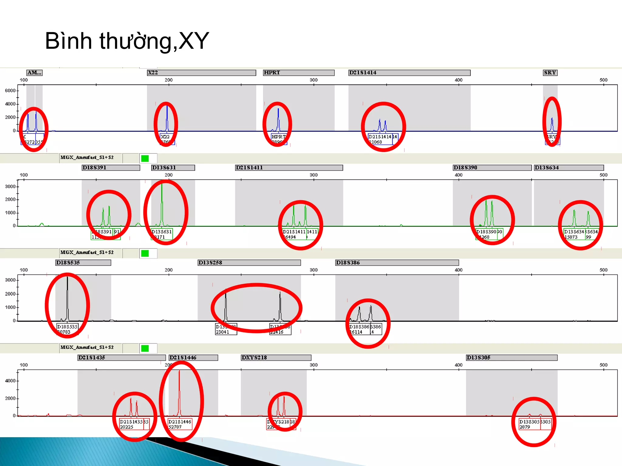 Nghiên cứu ứng dụng kỹ thuật QF-PCR trong chẩn đoán trước sinh các hội chứng lệnh bội nhiễm sắc ...