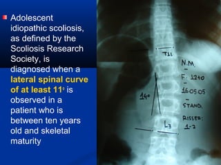 Braces scoliosis | PPT