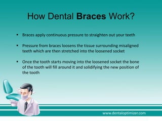 The Facts about Dental Braces | PPTX