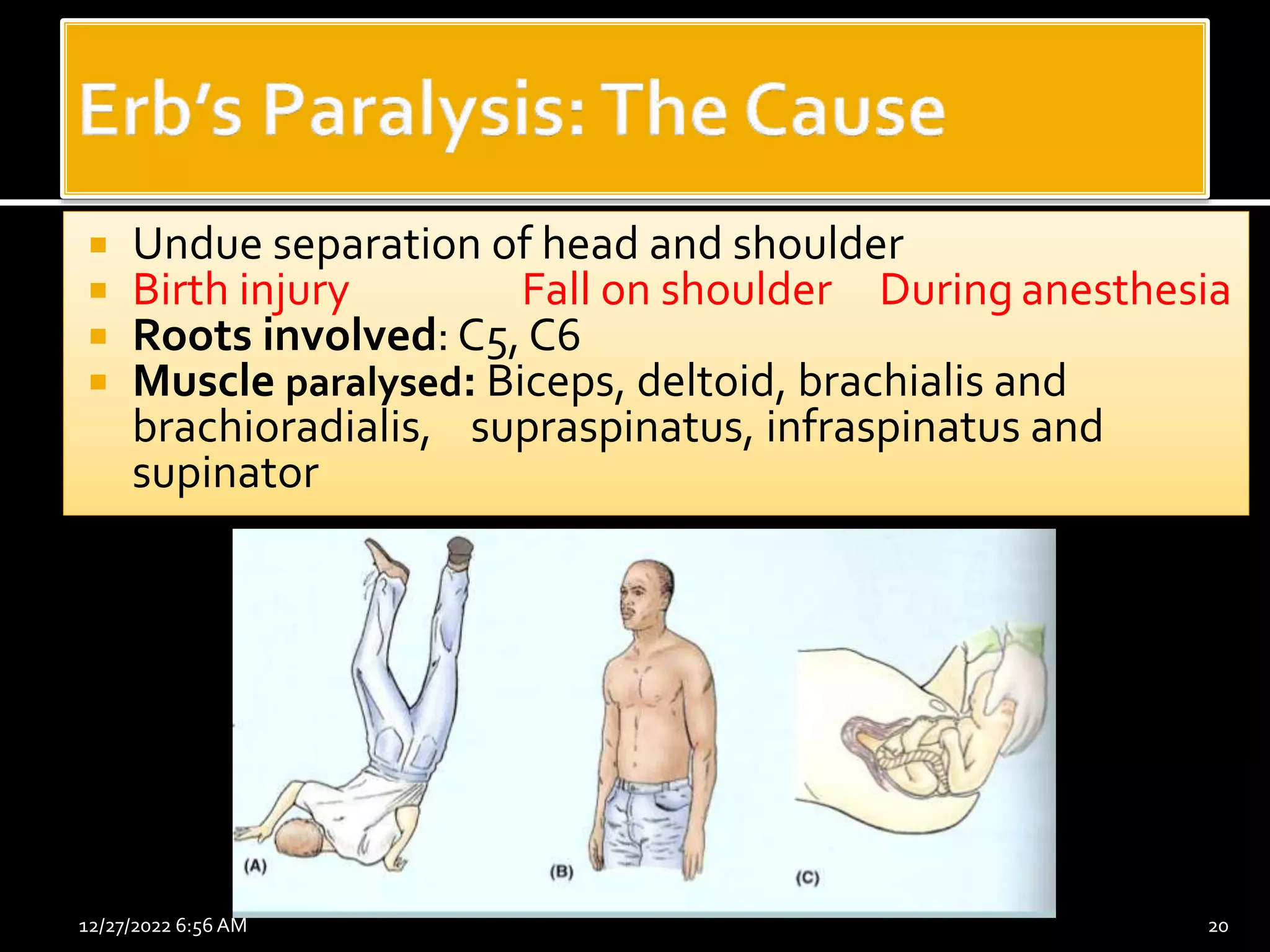 Brachial Plexus.pptx