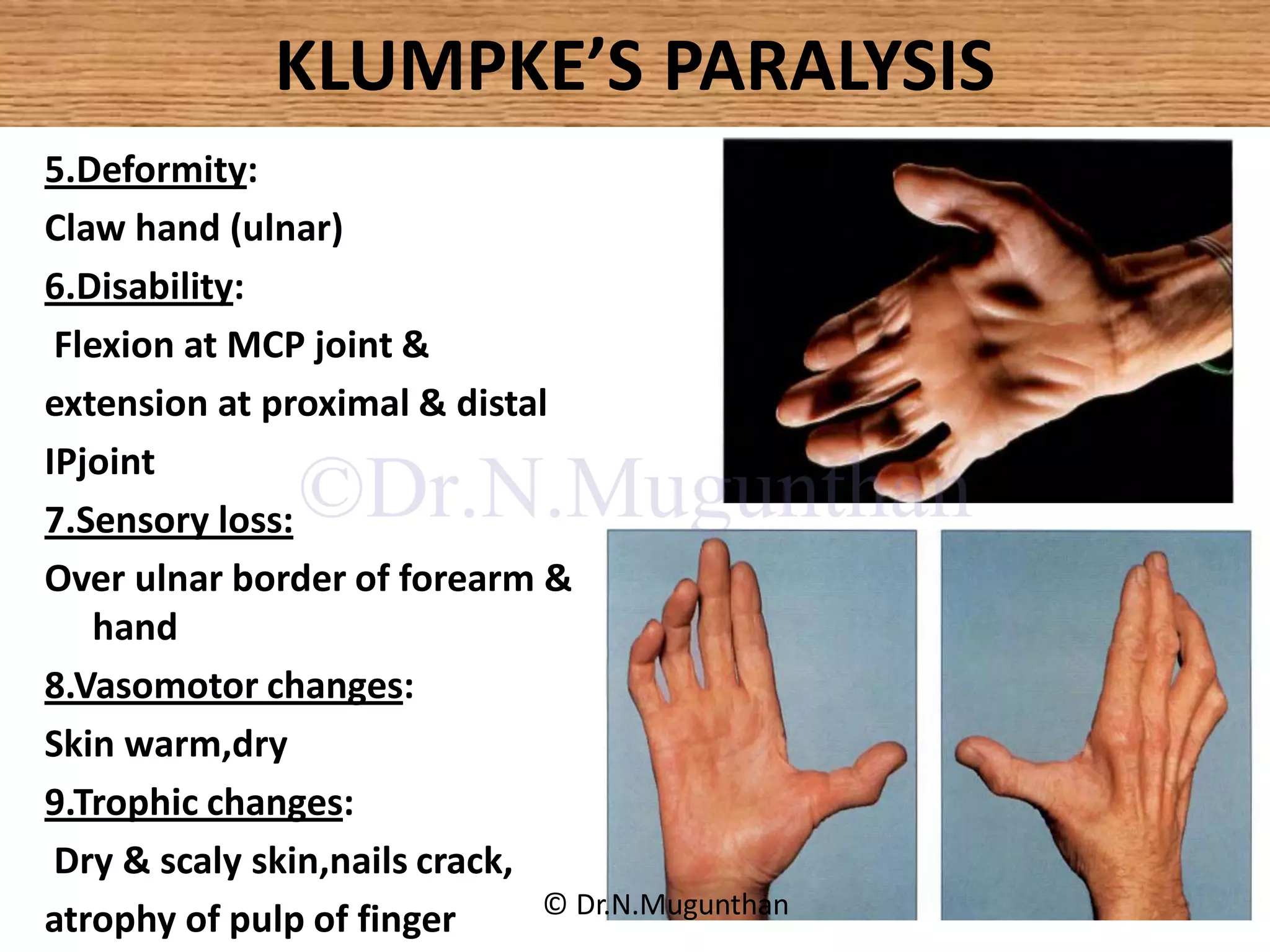 Brachial plexus Dr.N.Mugunthan | PDF