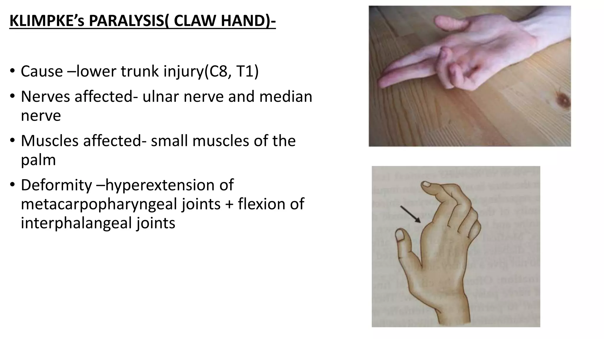 Brachial plexus and peripheral nerve lesion { 1821-1830 }.pptx