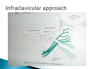 Infraclavicular Block
