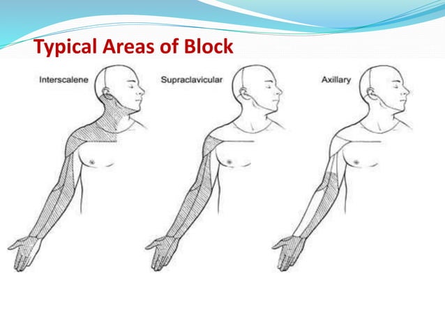 Brachial plexus block by PNS and ultrasound guided block