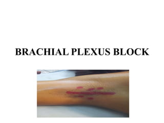 BRACHIAL PLEXUS BLOCK 1..............pptx