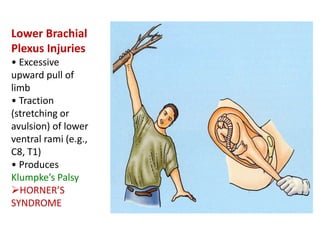 Brachial plexuses | PPT