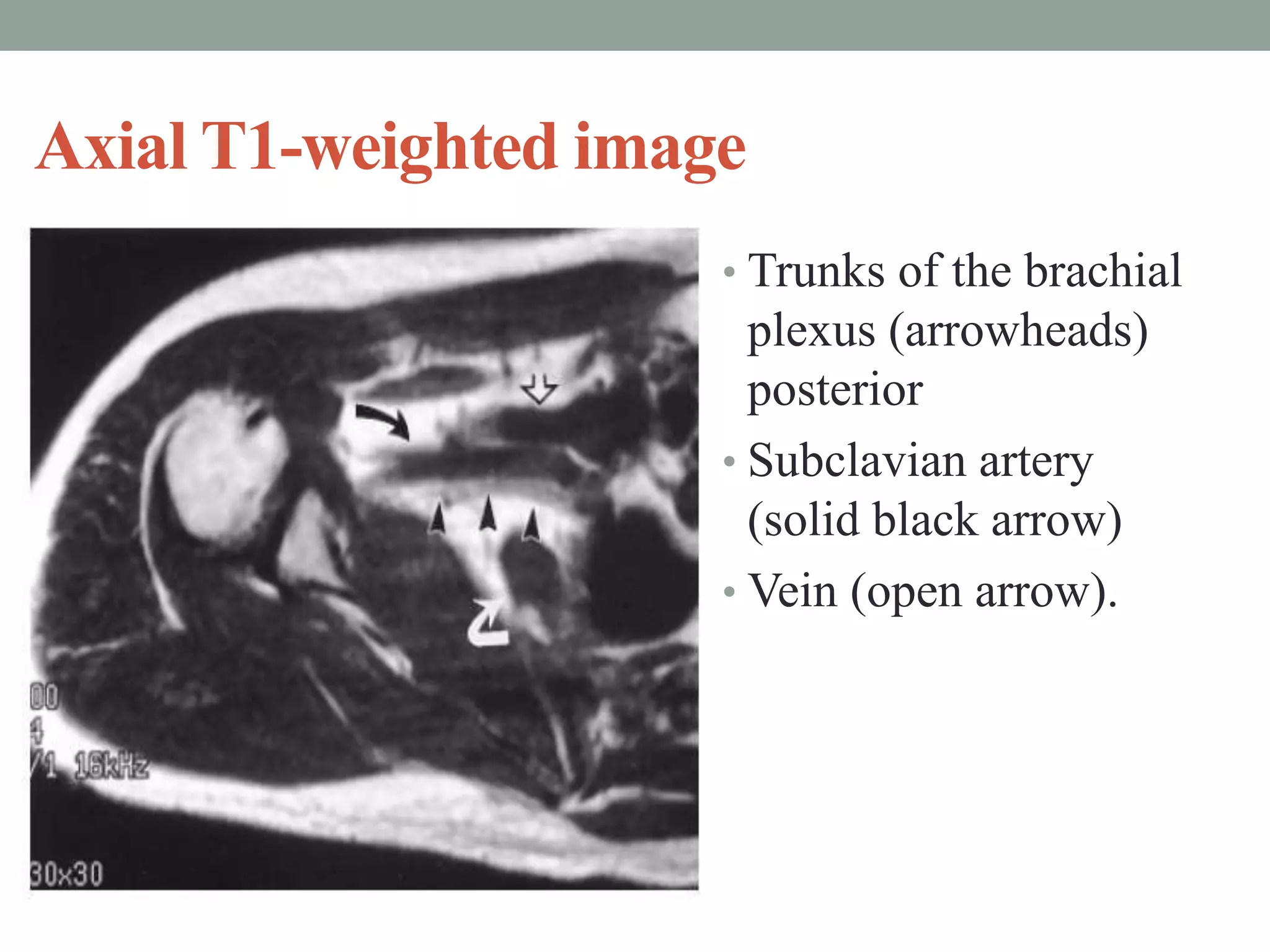 Brachial plexus imaging | PPTX