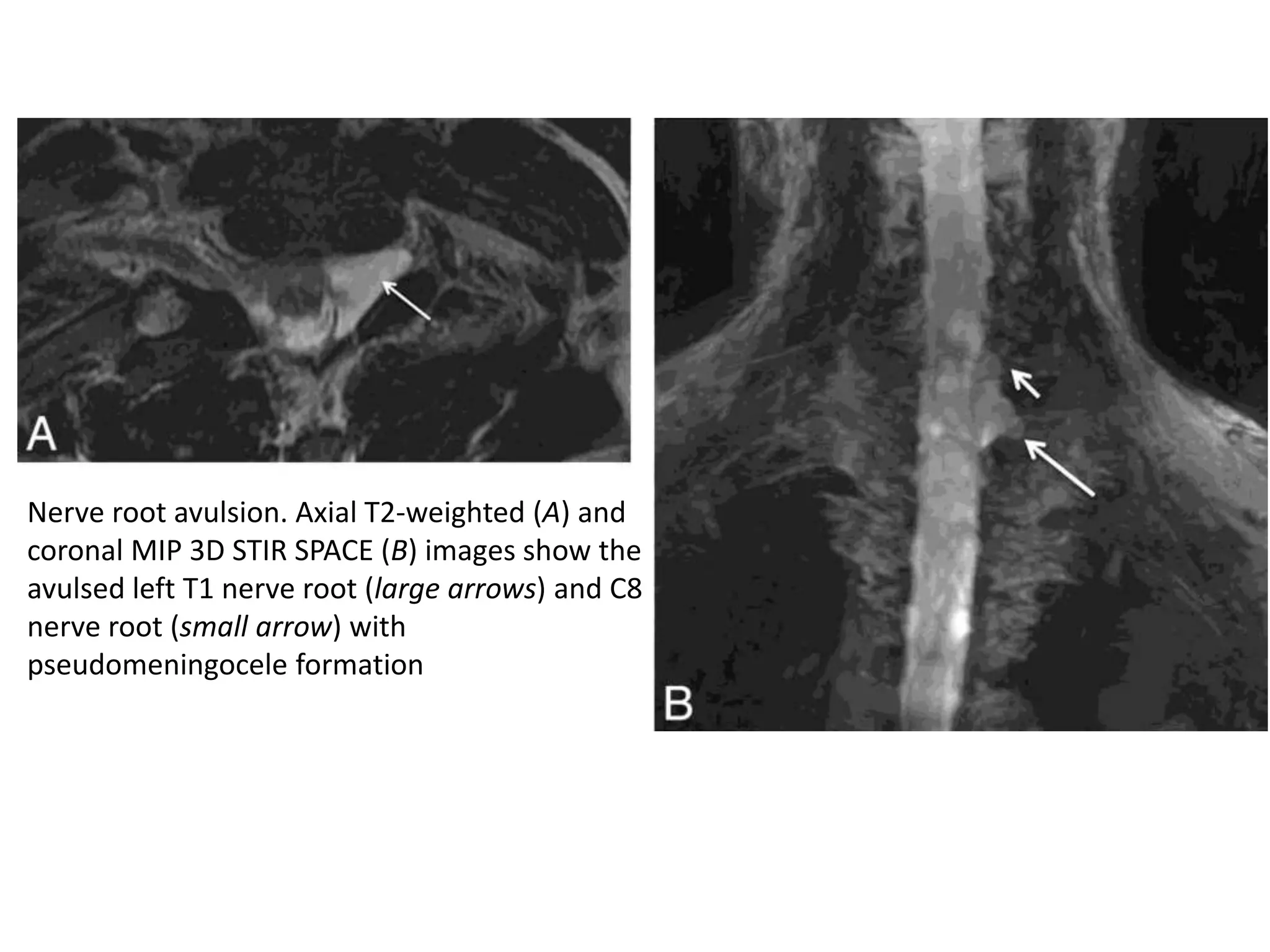 Brachial plexus injuries | PPTX