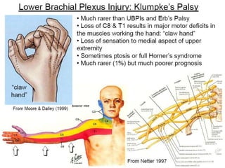 Klumpkes Palsy Presentation