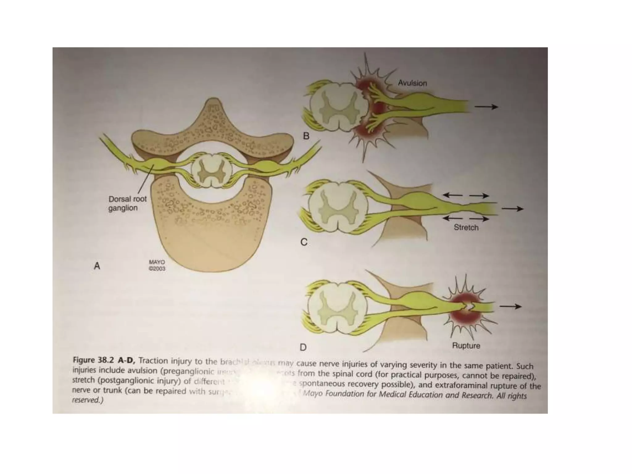 Brachial plexus injuries | PPTX