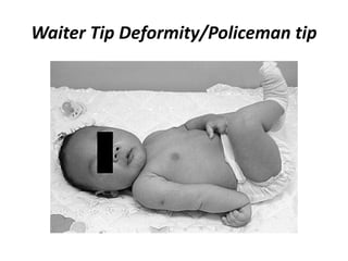 Brachial plexus injuries | PPT