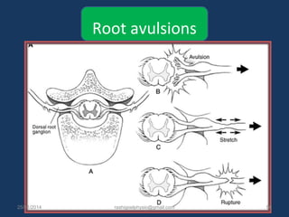 Brachial plexus injuries by Dr. Rashi Goel PT | PPT