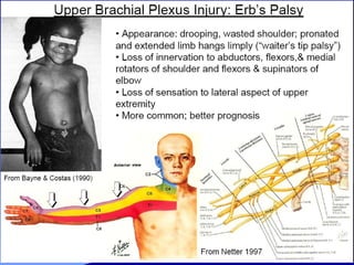 Waiters Tip Brachial Plexus