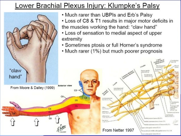 Brachial plexus injuries by krr