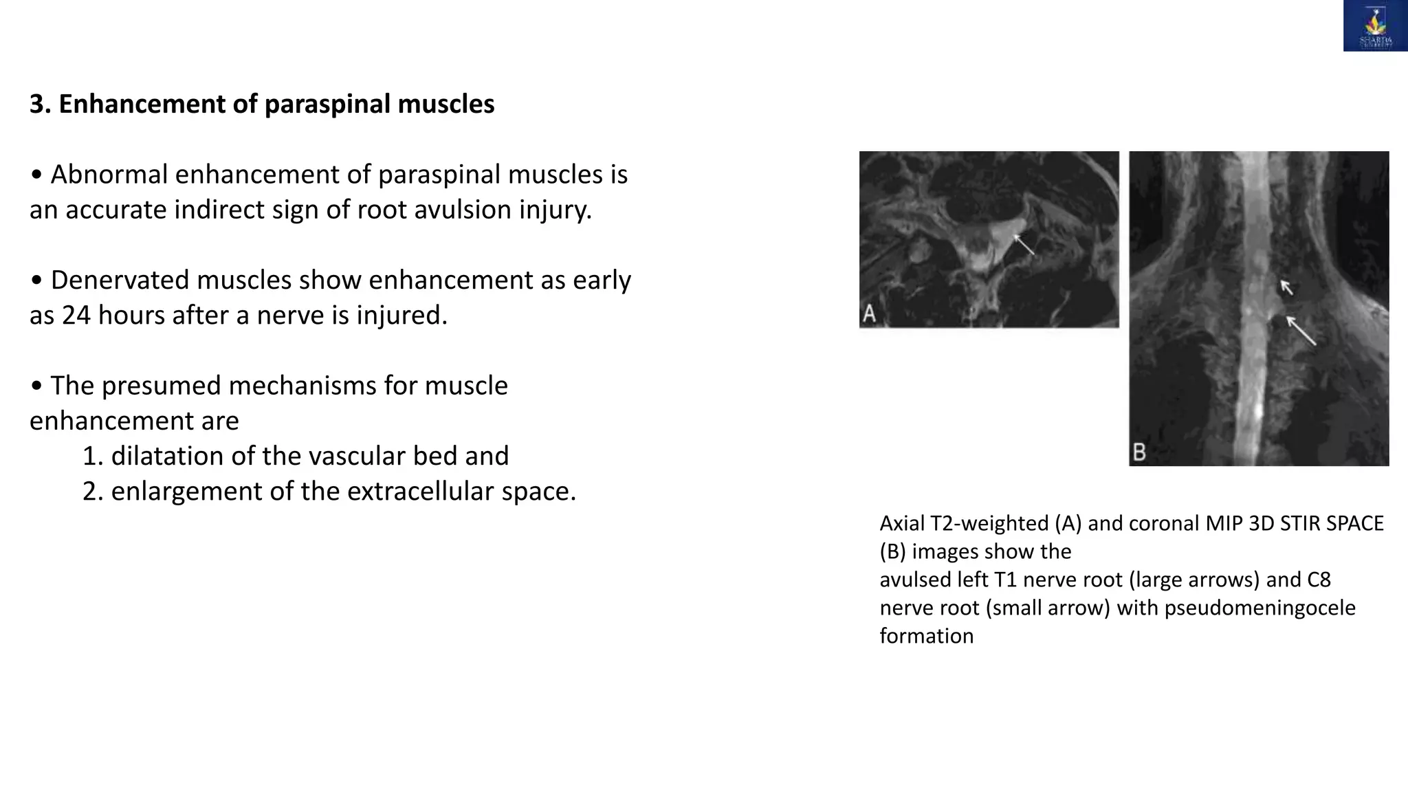 Brachial Plexus Injury | PPTX