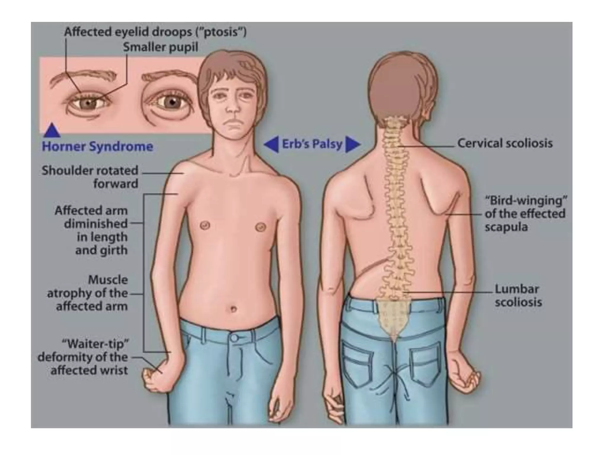 Brachial plexus injury | PPTX