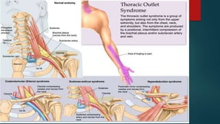 Brachial plexus injury and Thoracic outlet syndromes | PPTX