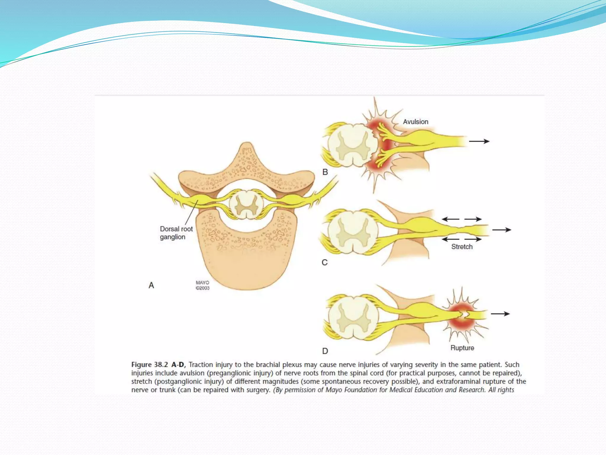 Brachial plexus injury diagnosis | PPT