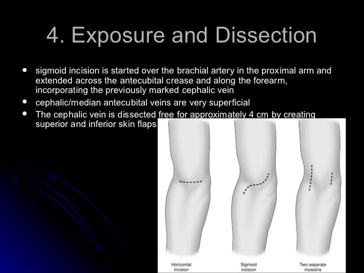 Brachiocephalic fistula