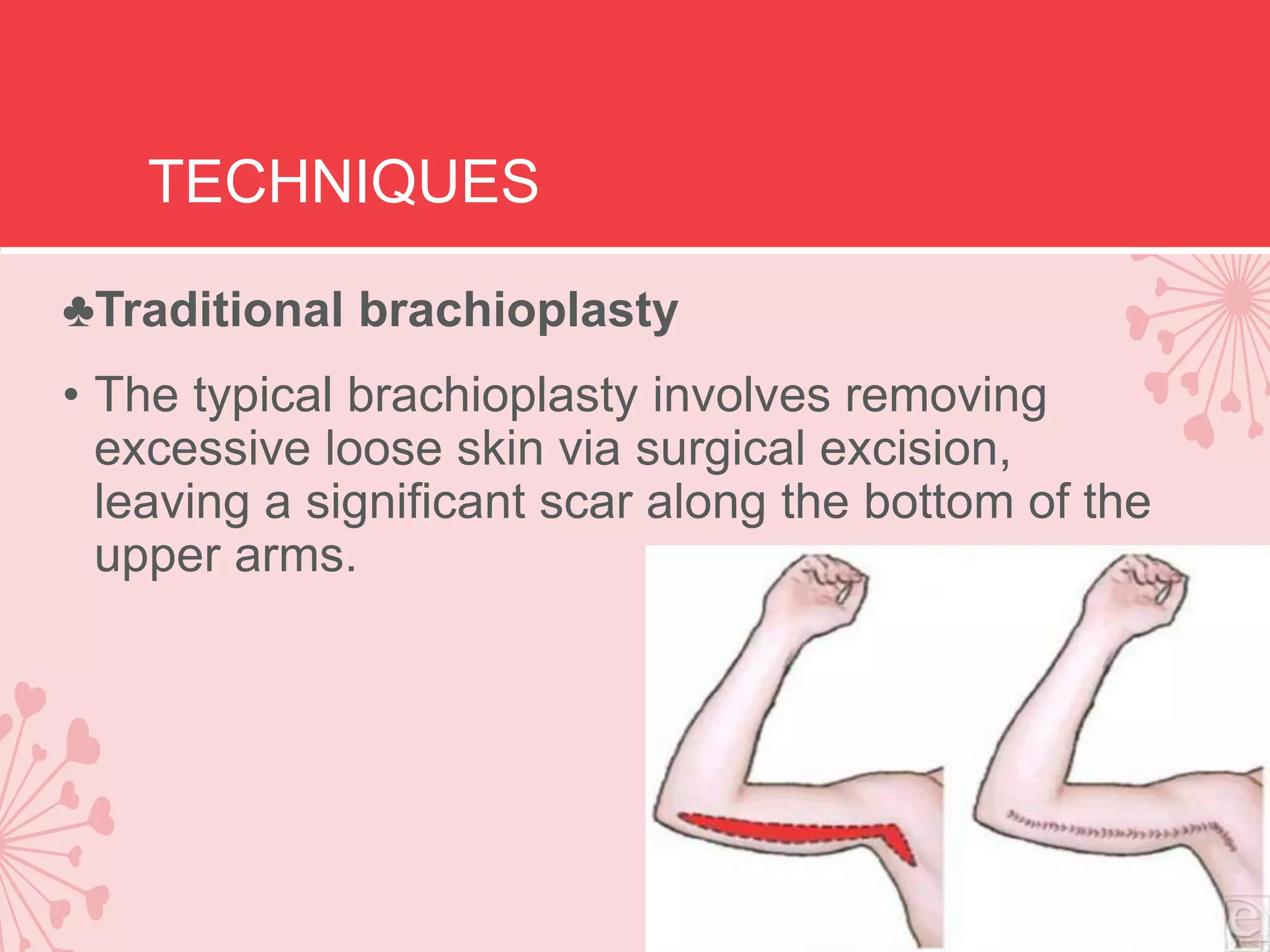 Brachioplasty | PPTX