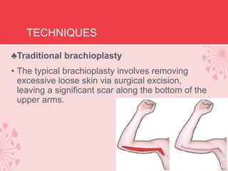 Brachioplasty Incision In The Armpit – EHJWG