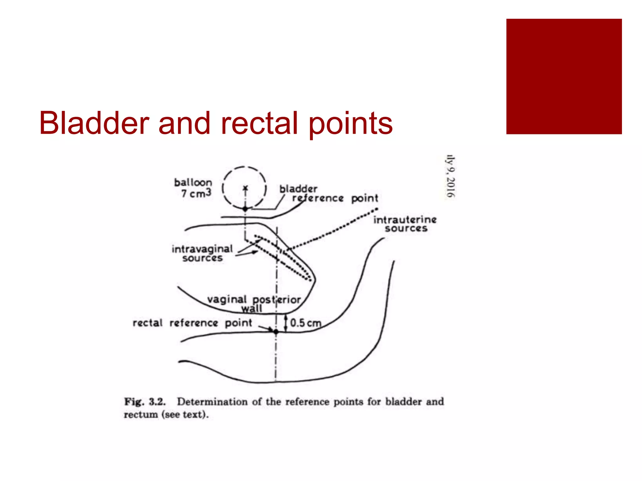 Evolution of Intra-cavitary Brachytherapy | PPTX