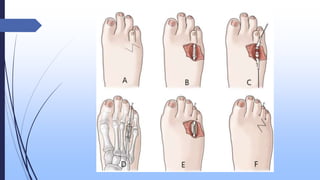 Brachymetatarsia | PPTX