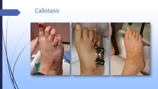 Brachymetatarsia | PPT