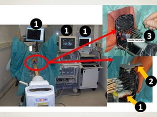 Brachytherapy | PPTX
