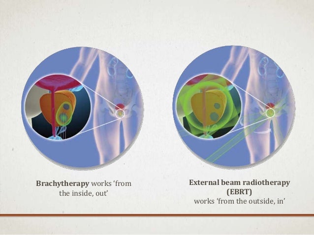Brachytherapy