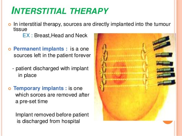 Brachytherapy.ar